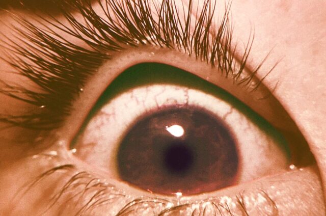 5 Most Common Types of Eye Disorder - Weird Worm