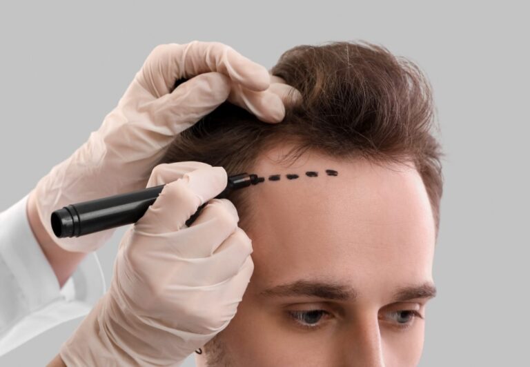 The Journey to Hair Restoration ─ Key Factors to Consider - Weird Worm