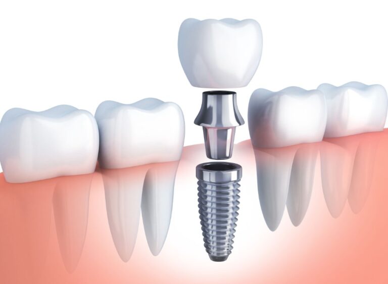 Discover the Best Dental Implants in Dallas for a Radiant Smile - Weird ...